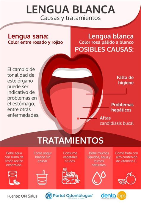 Lengua Blanca Causas Y Tratamientos Blanca Causas Lengua