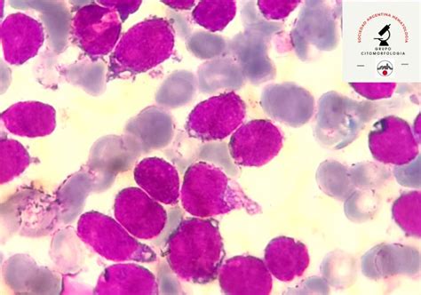 Sociedad Argentina De Hematolog A