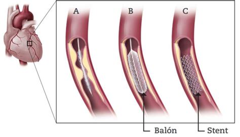 Proceso de instalación de un stent metálico a El catéter con guía