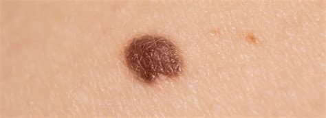 Enlever un grain de beauté pourquoi et comment Chirurgie