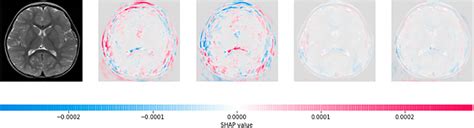 frontiers explanation driven deep learning model for prediction of brain tumour status using
