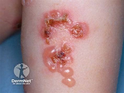 DermNet Linear IgA Bullous Disease A Complete Overview With Images