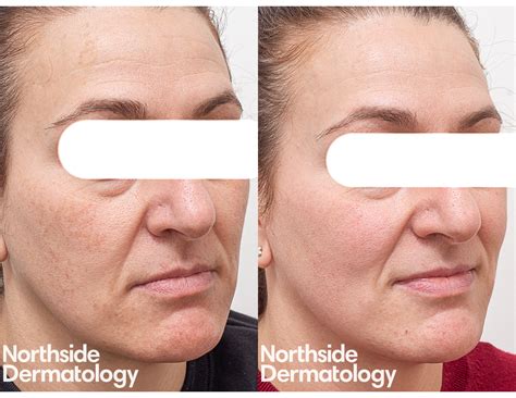 Q Switched Laser Melbourne Northside Dermatology