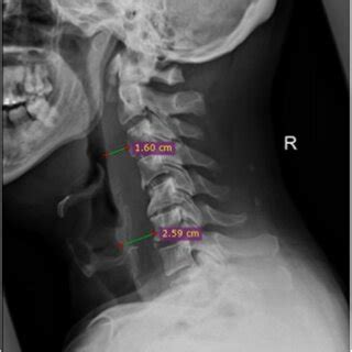 Lateral Cervical Radiograph Showing Thickened Pre Vertebral Soft Tissue