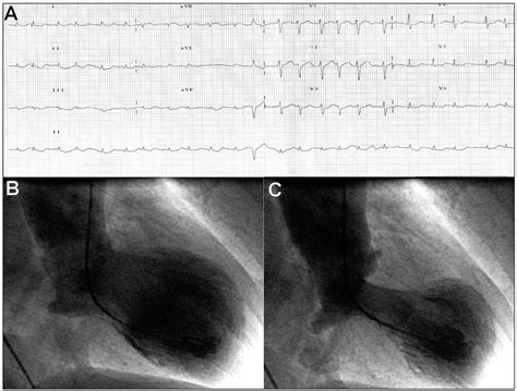 Broken Heart Syndrome Tako Tsubo Cardiomyopathy Cmaj