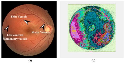 Applied Sciences Free Full Text Retinal Vessels Segmentation
