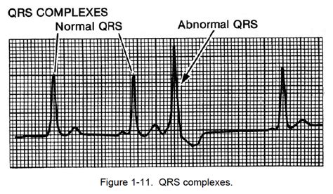 figure 1 11 qrs complexes cardiac rhythm interpretation