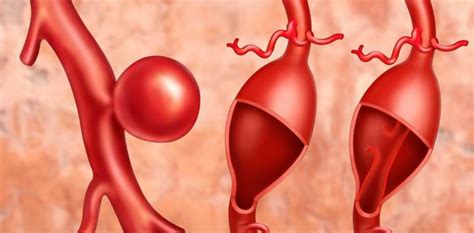 El aneurisma de aorta abdominal mejora al inhibir una proteína