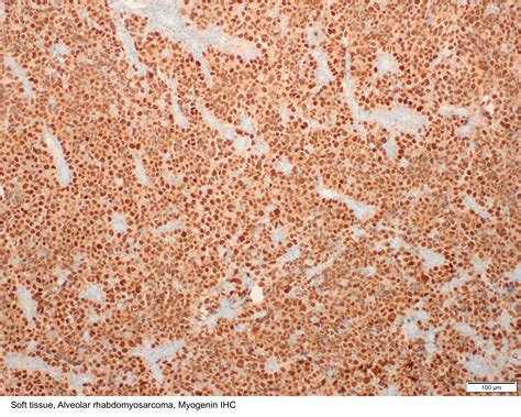 Pathology Outlines Alveolar Rhabdomyosarcoma
