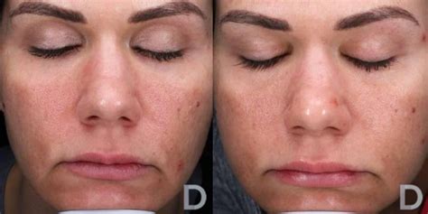 Aparat De Microneedling Cu Radiofrecventa VIVACE Fractional