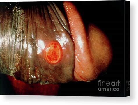 Syphilis Chancre In Women