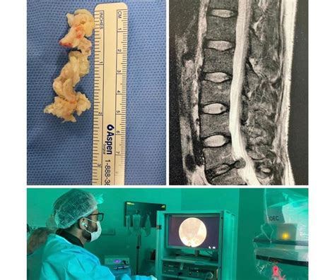 Cirurgia Minimamente Invasiva Da Coluna Vantagens Procedimento