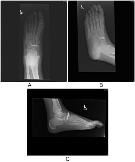 Navicular Stress Fractures Christopher E Gross James A Nunley 2015
