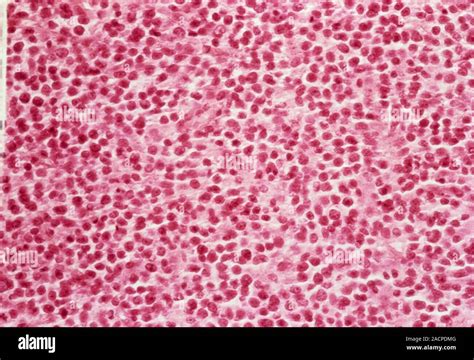 Reticulosarcoma Light Micrograph Of Reticulocyte Blood Cells Red One