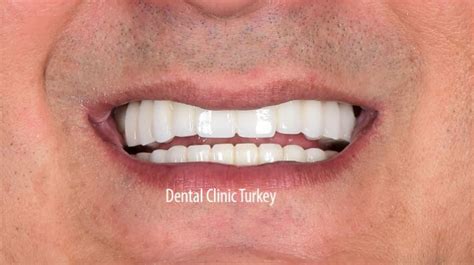 All On 6 Dental Implant Procedure In Turkey Cost Advantages