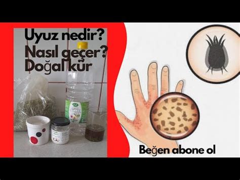 uyuz nasıl geçer uyuz nedir Doğal kurler YouTube