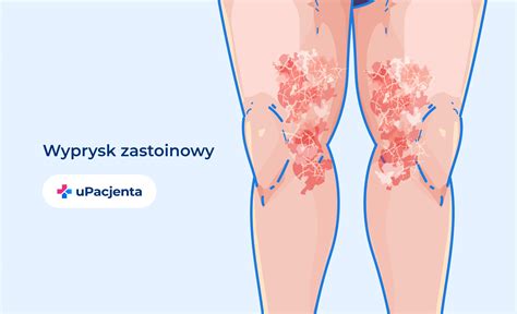 Egzema początki rodzaje objawy
