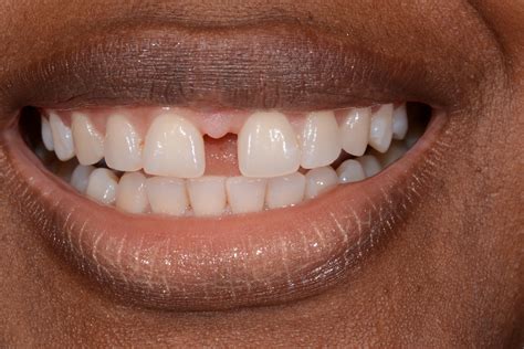Fixing Gaps Between Front Teeth