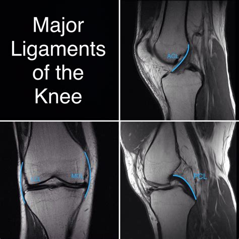 Normal Knee Ligaments Anterior Cruciate ACL Posterior Cruciate PCL