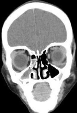Orbital Infection Imaging Practice Essentials Computed Tomography