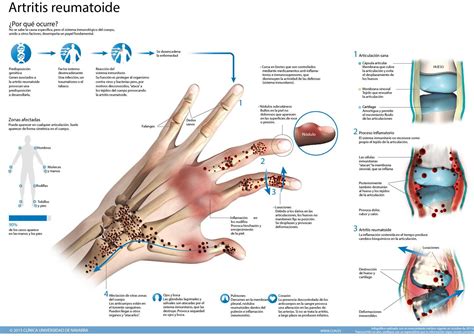 Pdf Artritis Reumatoide S Ntomas Artritis Reumatoide Causas The Best