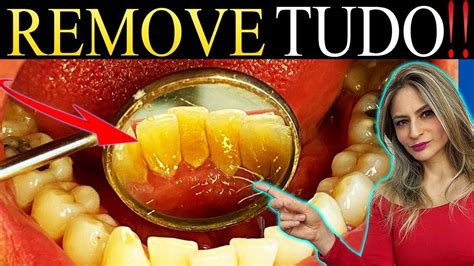 Receita Caseira Infal Vel De Como Remover O T Rtaro Dos Dentes Em