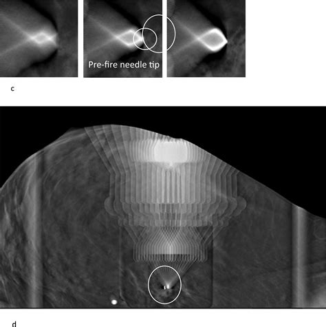 Digital Breast Tomosynthesis Dbt Guided Biopsy Of Calcifications