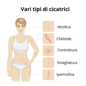 Il Trattamento Delle Cicatrici E La Fisioterapia Fisiosalus Perugia