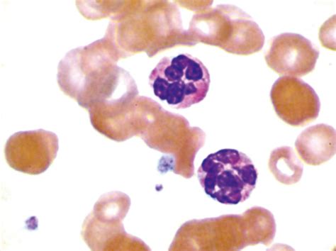 Macrocytic Anemia Flashcards Quizlet