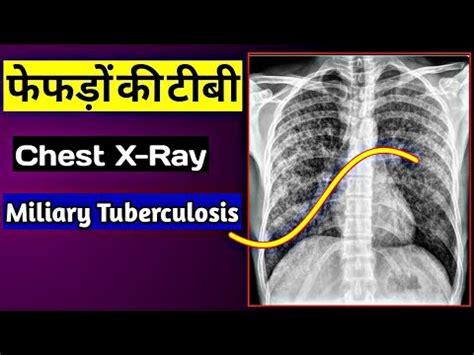 Icd Normal Chest X Ray For Tuberculosis Hot Sex Picture