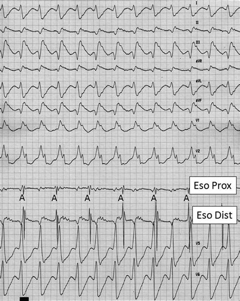 General Approach To A Wide QRS Complex Cardiac Electrophysiology Clinics