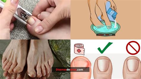 Cómo cortarse las uñas de los pies para evitar Uñas Encarnadas