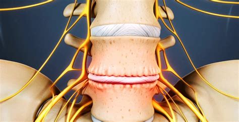 La Radiculopat A Lumbar Causante De La Ci Tica Doctor Carlos Ochoa