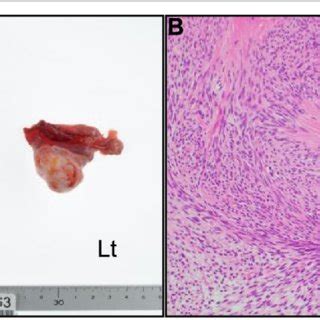 Macroscopic Image Of Resected Ovarian Tumors And Pathological Findings