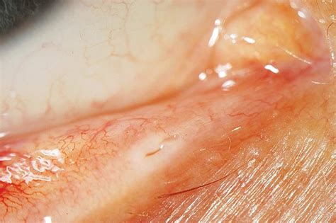 Lacrimal Punctum