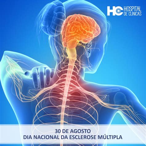 Dia Nacional De Conscientiza O Sobre A Esclerose M Ltipla Hospital