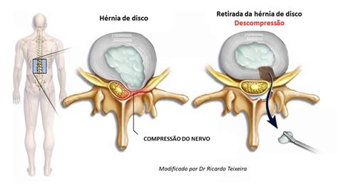 Cirurgia de Hérnia de Disco Lombar Dr Ricardo Teixeira
