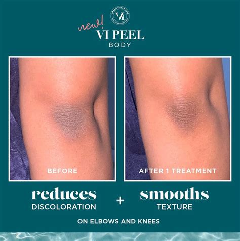 Chemical Peels Revive Med Spa