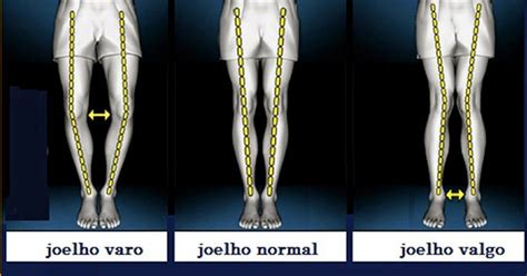 A prevenção e tratamento do Joelho Geno Valgo Prevenção Exercícios