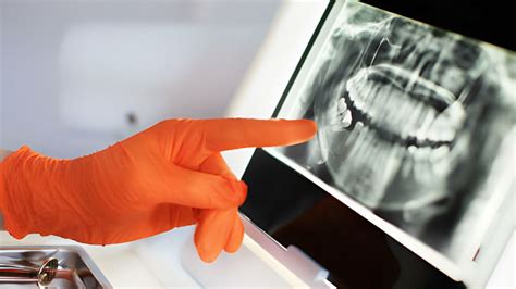 Panoramica Dental Veja Tudo Sobre Esse Tipo De Radiografia