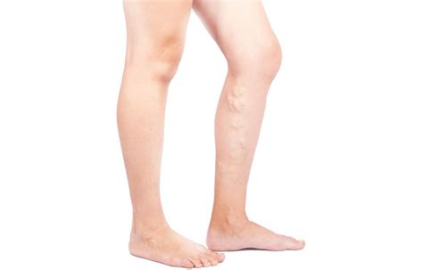 Flebite E Tromboflebite Conhe A Fatores De Risco