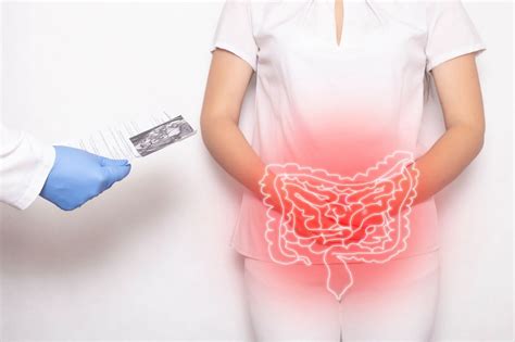 Leczenie choroby uchyłkowej jelita grubego Szpital Matki Bożej
