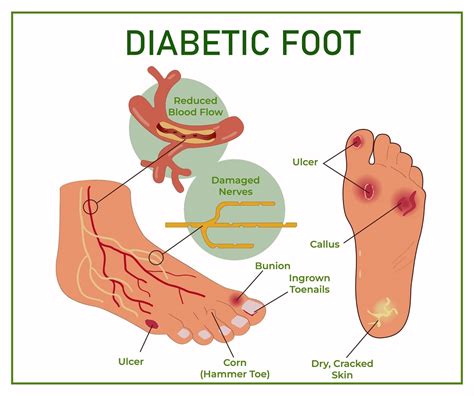 Arterial Ulcer On Foot Online Emergencydentistry