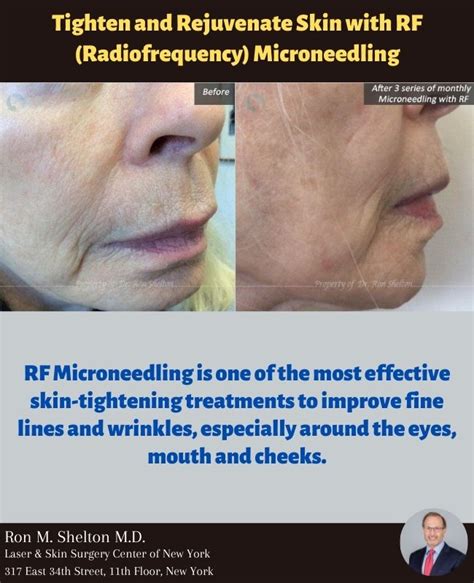 Tighten And Rejuvenate Skin With RF Microneedling Dr Ron Shelton