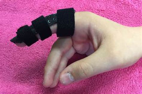 Volar Plate Injury Hand Therapy Group