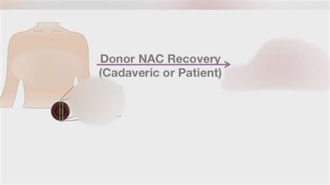 New Breast Cancer Reconstruction Surgery YouTube