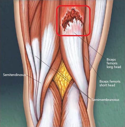 Rotura Del B Ceps Femoral Cl Nica Campos
