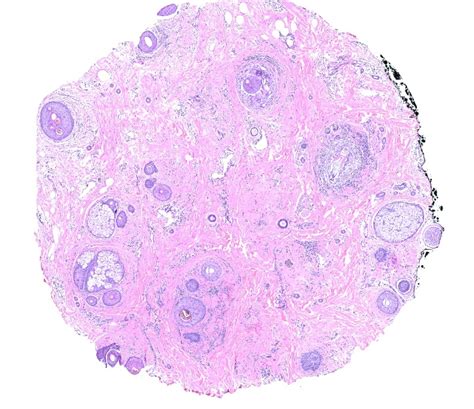 Simon Roy Md On Twitter Inflammatory Cicatricial Alopecia Example
