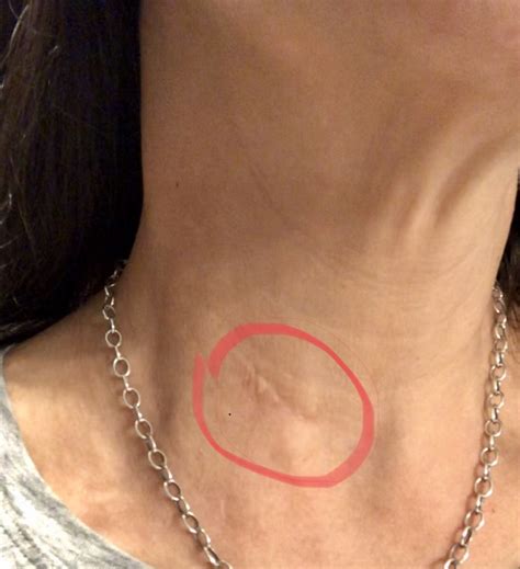 List 91 Pictures Photos Of Anterior Hip Replacement Scars Sharp