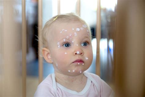 Ospa wietrzna u niemowlaka objawy leczenie i pielęgnacja Mjakmama24 pl